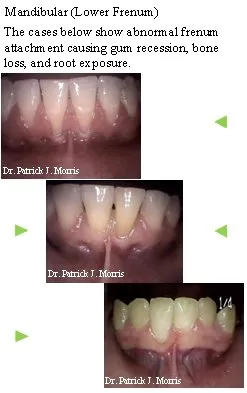 Frenectomy Lee's Summit MO | Morris Periodontics